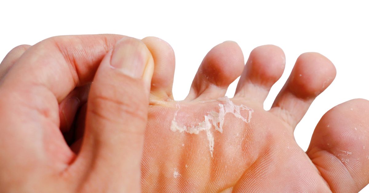 Mycose du pied (Tinea Pedis) | Symptômes et traitement 2025